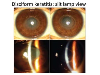 Cornea -immune mediated disorders | PPTX