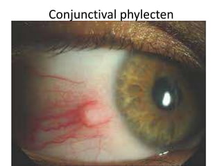 Cornea -immune mediated disorders | PPTX
