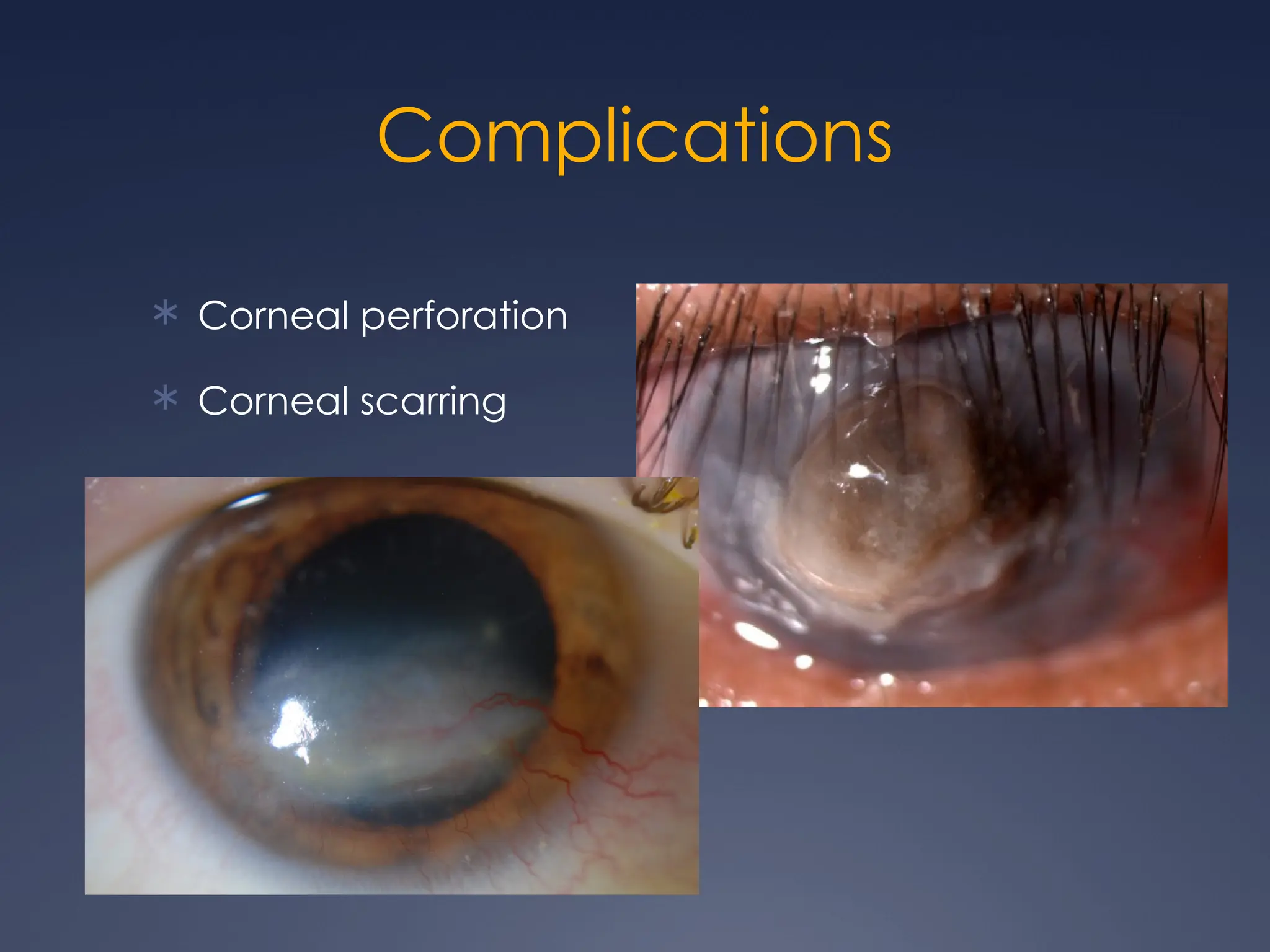 Cornea presentation including infectious disease | PPTX