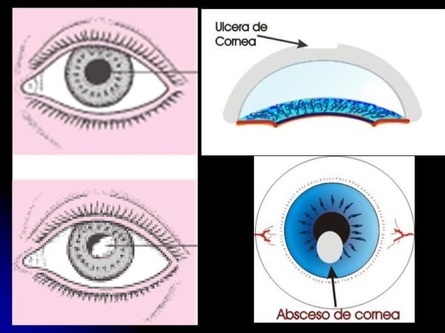 Cornea y sus alteraciones | PPT