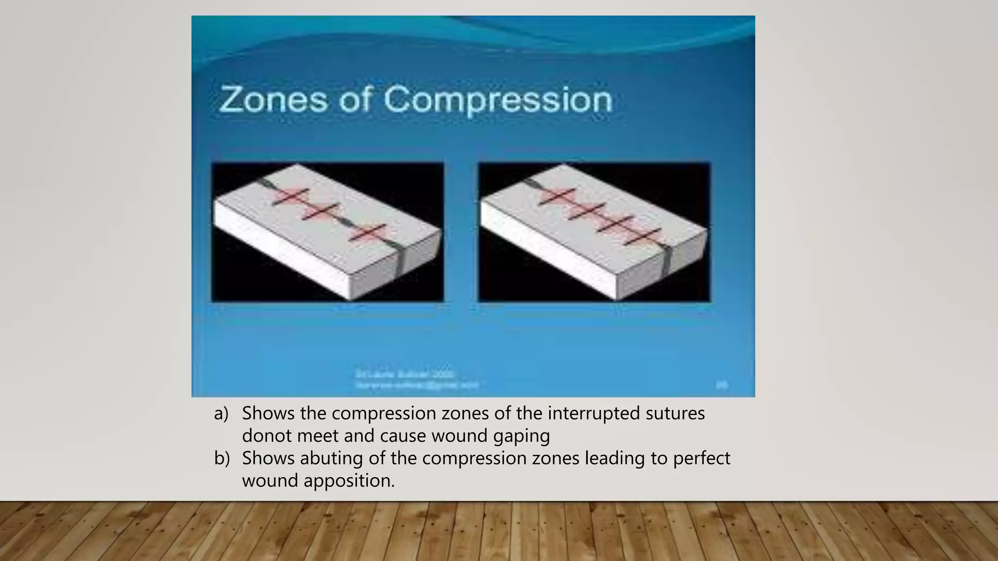 Corneo scleral trauma repair | PPTX