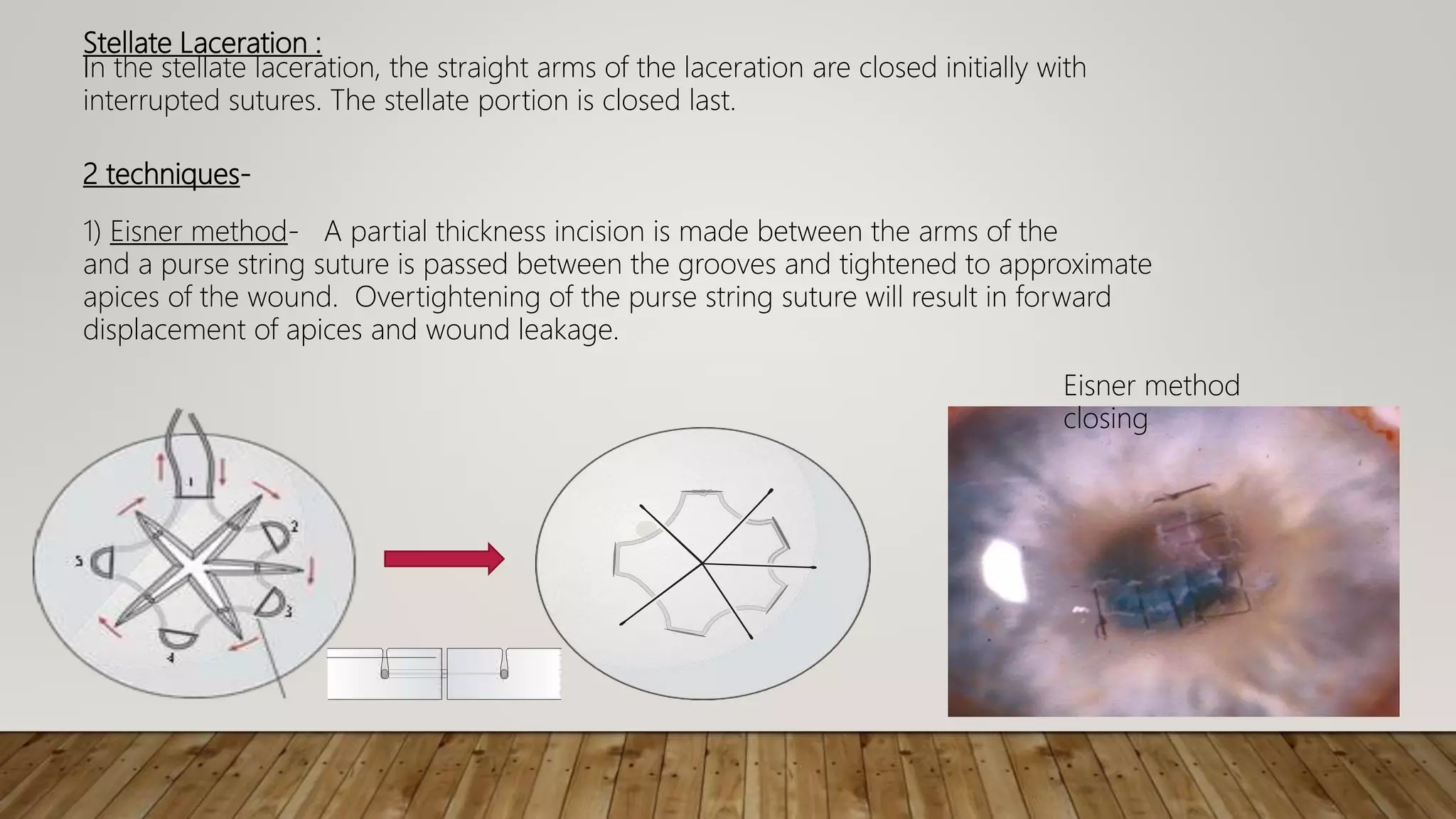 Corneo scleral trauma repair | PPTX