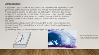Corneo scleral trauma repair | PPTX