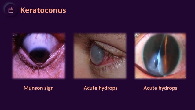 corneal,scleral and episcleral diseases.pptx