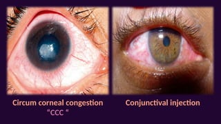 corneal,scleral and episcleral diseases.pptx