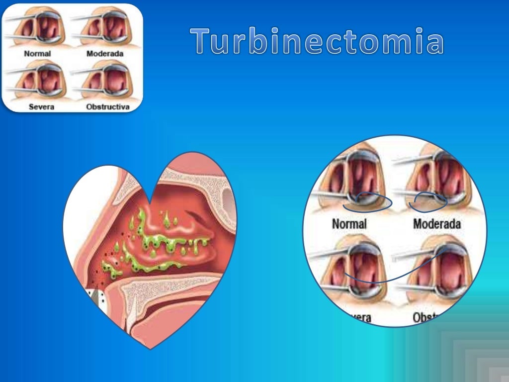 Cornetes nasales inferiores