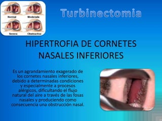 Cornetes Nasales Inferiores 1 Pptx