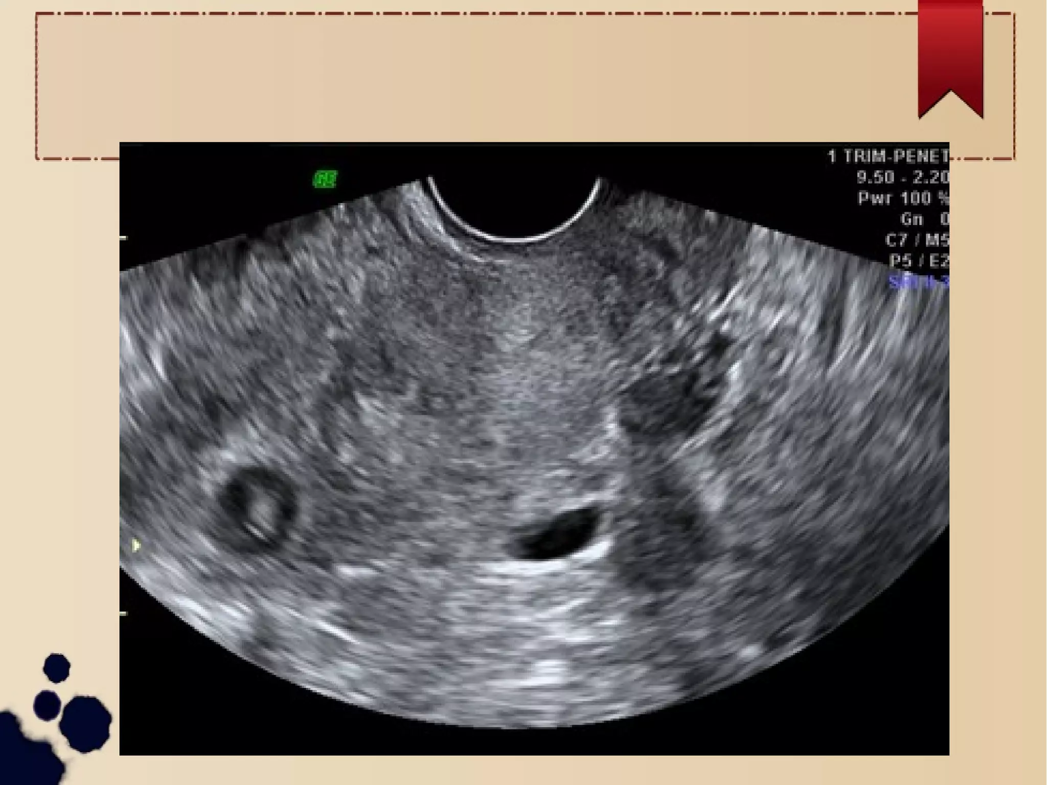 Cornual ectopic case series | PPT