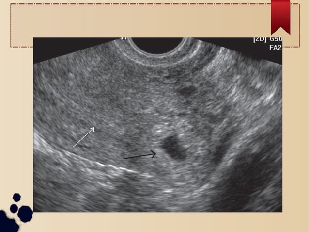 Cornual ectopic case series | PPT