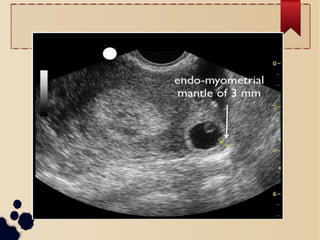 Cornual ectopic case series | PPT