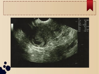 Cornual ectopic case series | PPT