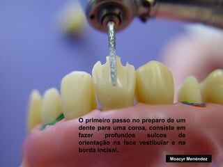 Preparo Dental para Coroa Metalo Cerâmica Anterior | PPT