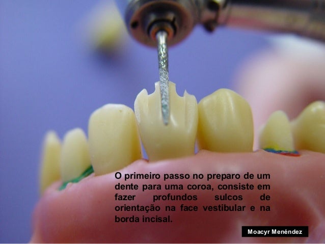 Preparo Dental para Coroa Metalo Cerâmica Anterior