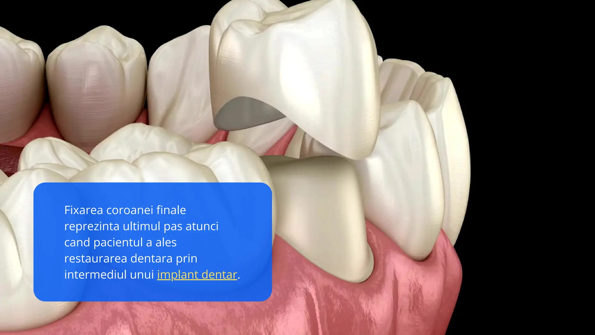 Coroana pe implant dentar - Tipuri si avantaje | PPT
