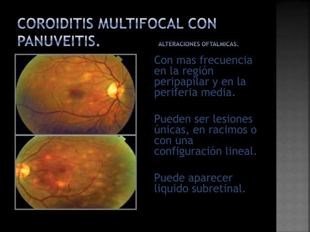 Coroiditis multifocal con_panuveitis
