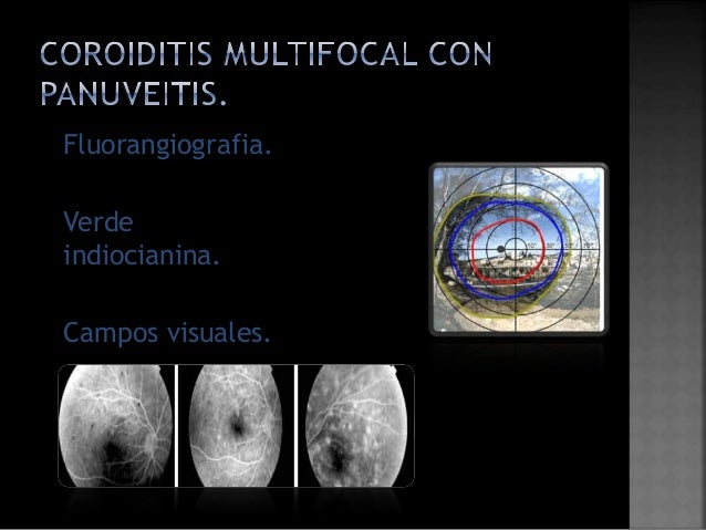 Coroiditis multifocal con_panuveitis