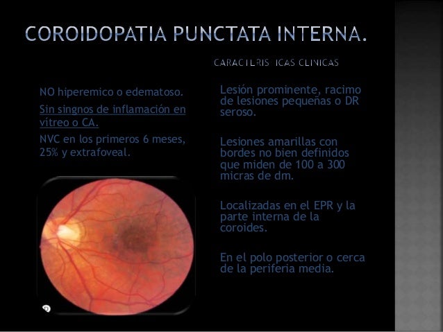 Coroiditis multifocal con_panuveitis