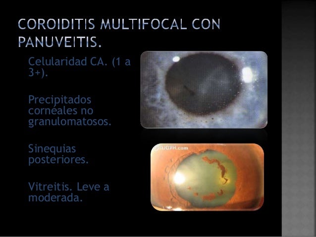 Coroiditis multifocal con_panuveitis