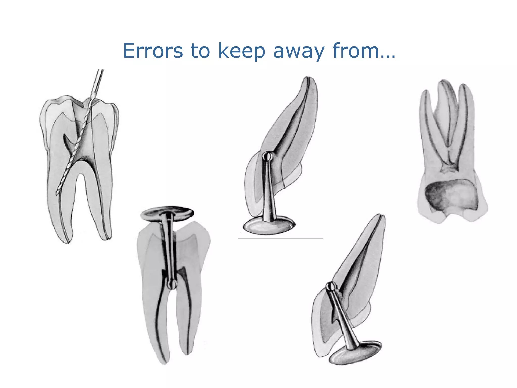 Coronal Cavity Preparation ‘Access’ | PPT