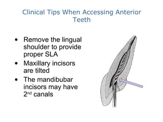 Coronal Cavity Preparation ‘Access’ | PPT
