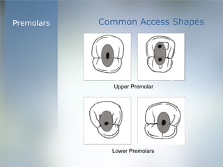 Coronal Cavity Preparation ‘Access’ | PPT