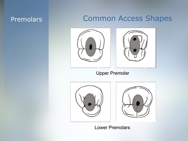 Coronal Cavity Preparation ‘Access’ | PPT | Dental Health | Diseases ...