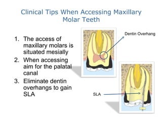 Coronal Cavity Preparation ‘Access’ | PPT