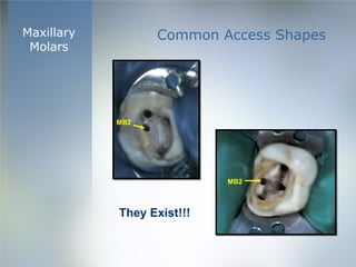 Coronal Cavity Preparation ‘Access’ | PPT