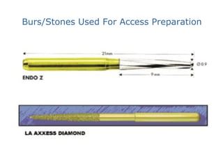 Coronal Cavity Preparation ‘Access’ | PPT