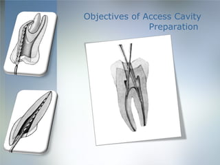 Coronal Cavity Preparation ‘Access’ | PPT