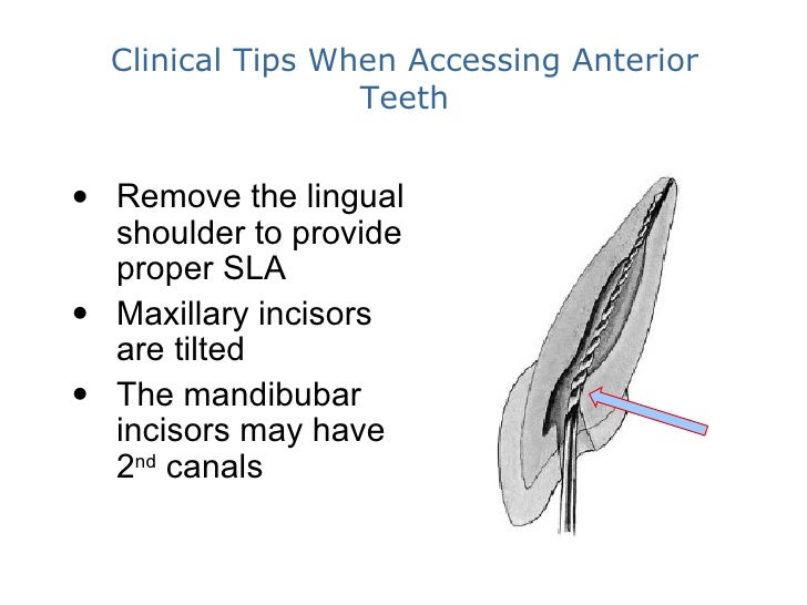 Coronal Cavity Preparation ‘Access’