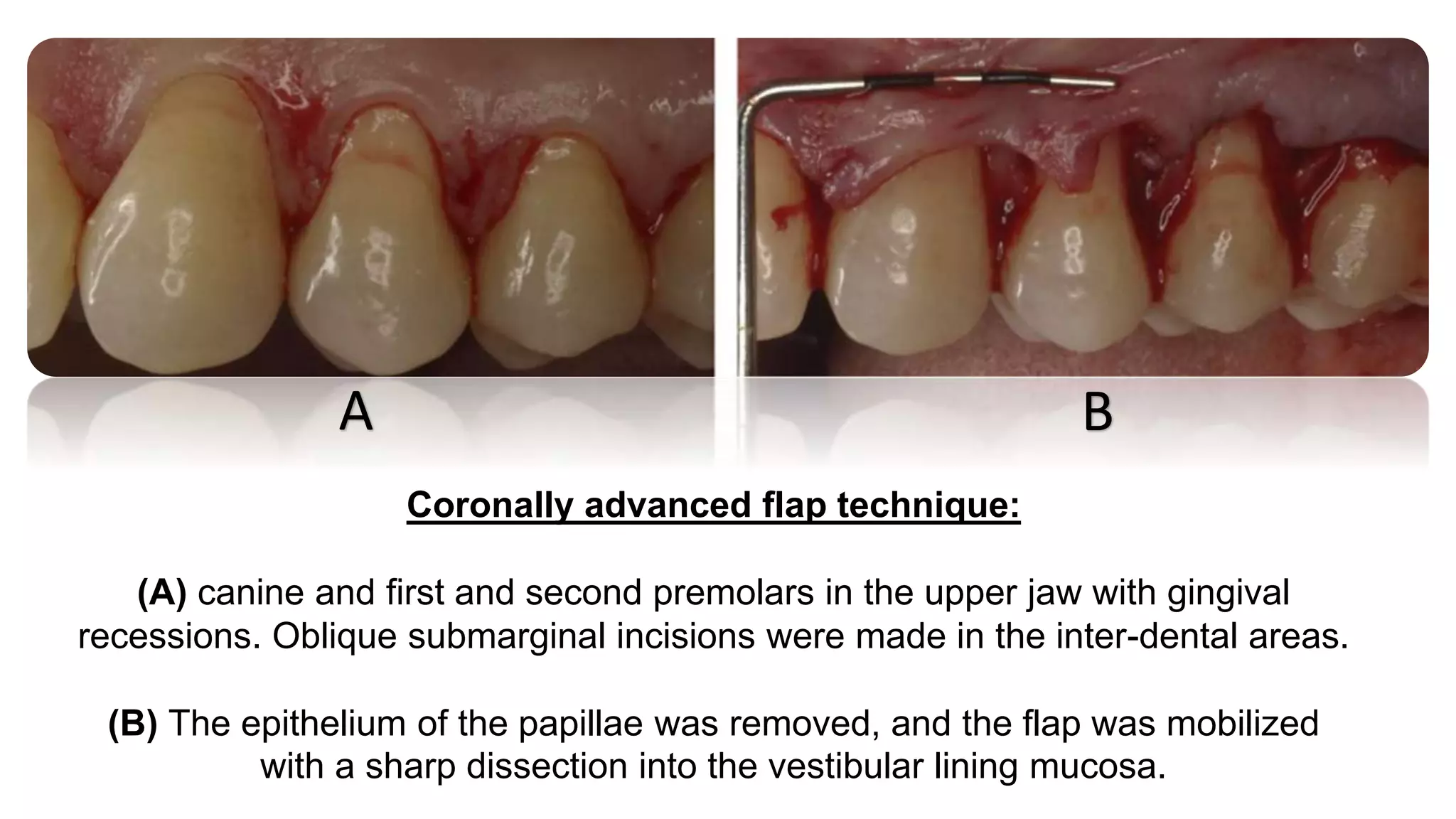 Coronal advanced flap in combination with a connective tissue graft. Is ...