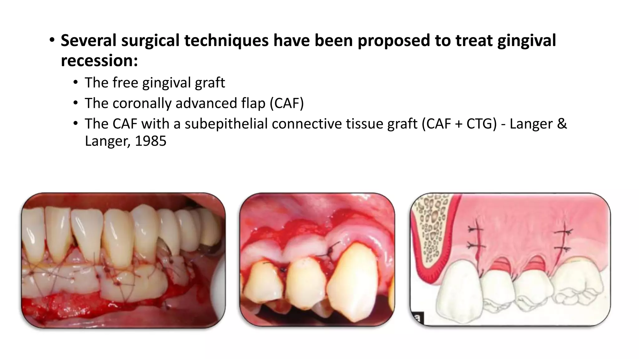 Coronal advanced flap in combination with a connective tissue graft. Is ...
