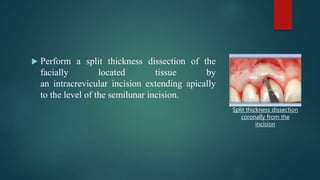 Coronal Positioned Pedicle Graft | PPTX | Dental Health | Diseases and ...
