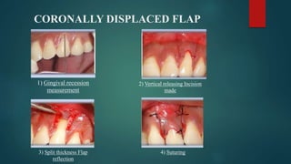 Coronal Positioned Pedicle Graft | PPTX | Dental Health | Diseases and ...
