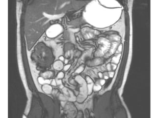 Colo-colic intussusception | PPT