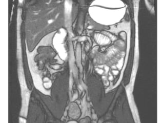 Colo-colic intussusception | PPT