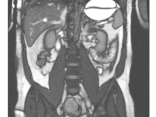 Colo-colic intussusception | PPT