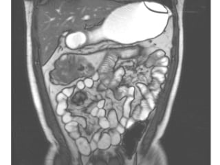 Colo-colic intussusception | PPT
