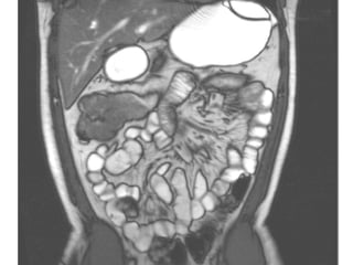 Colo-colic intussusception | PPT