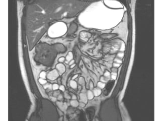 Colo-colic intussusception | PPT