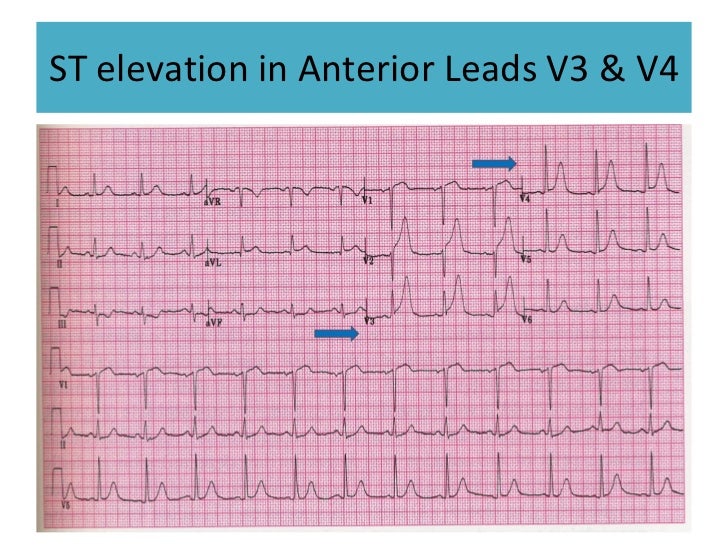 Coronary Arteries & 12-Leads