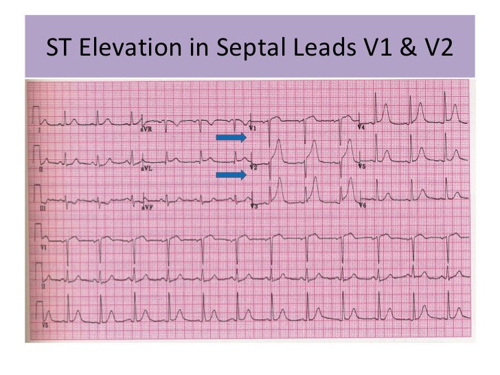 Coronary Arteries & 12-Leads