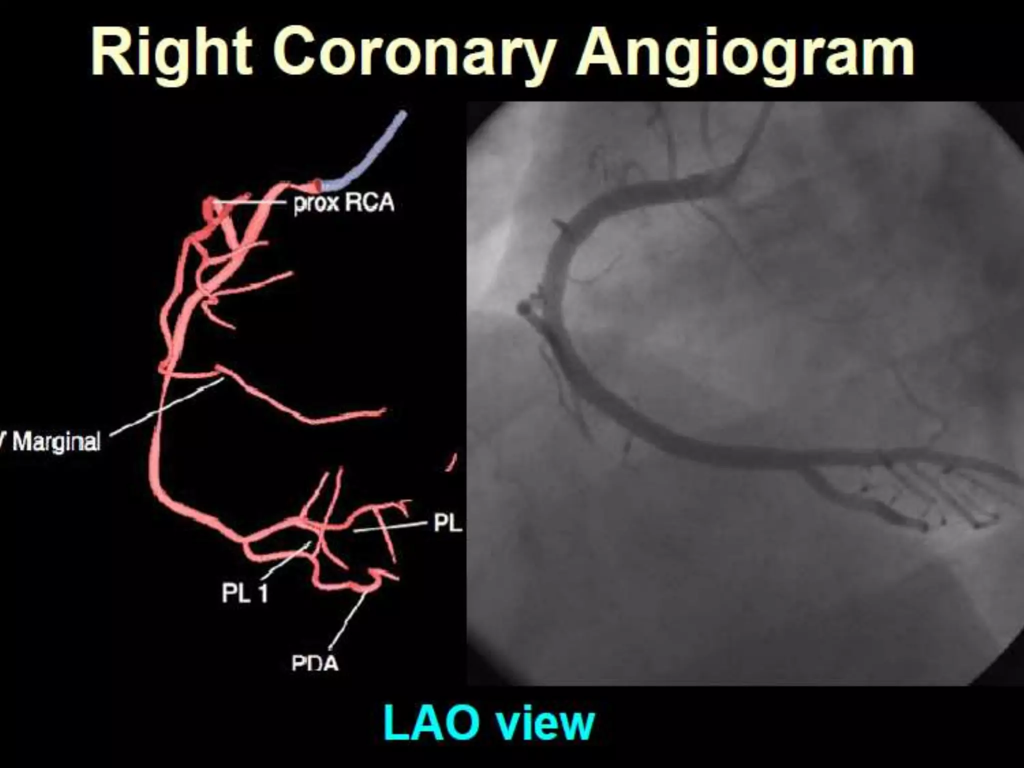 Coronary Angiogram | PPT