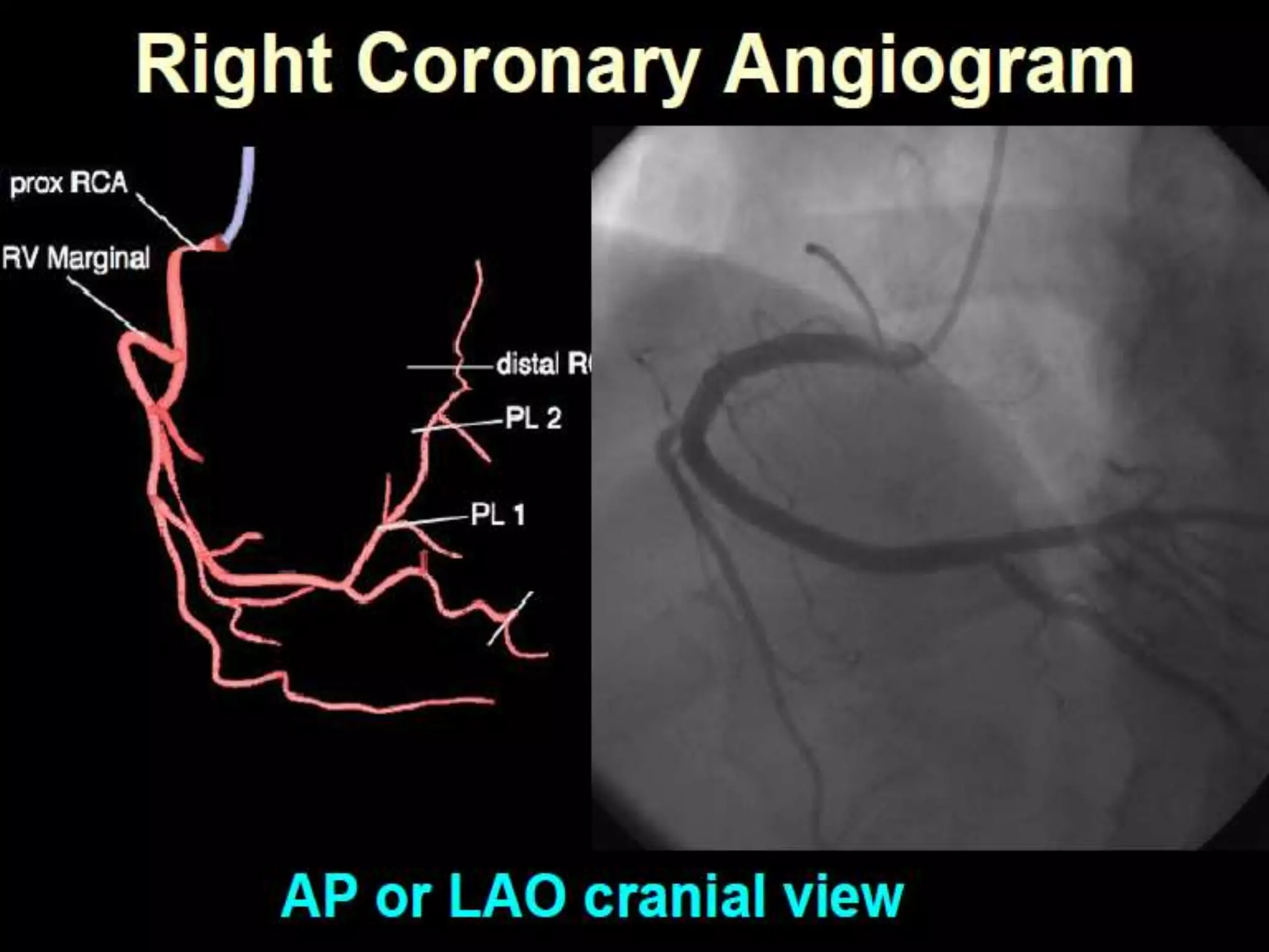 Coronary Angiogram | PPT