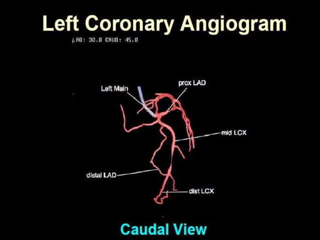 Coronary Angiogram | PPT