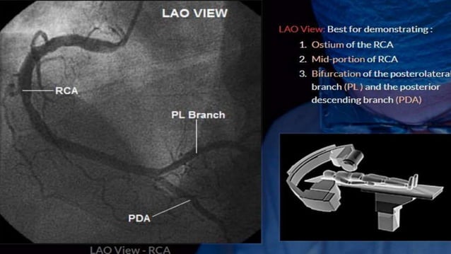 CORONARY__ANGIOGRAM-and-Angiography.pptx