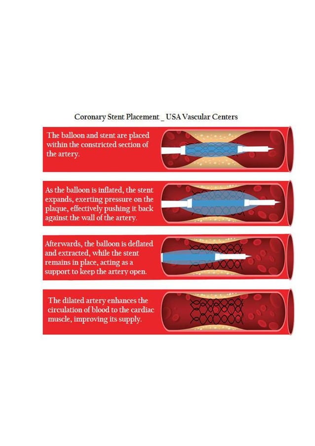 What is an Angioplasty Procedure | USA Vascular Centers | PDF