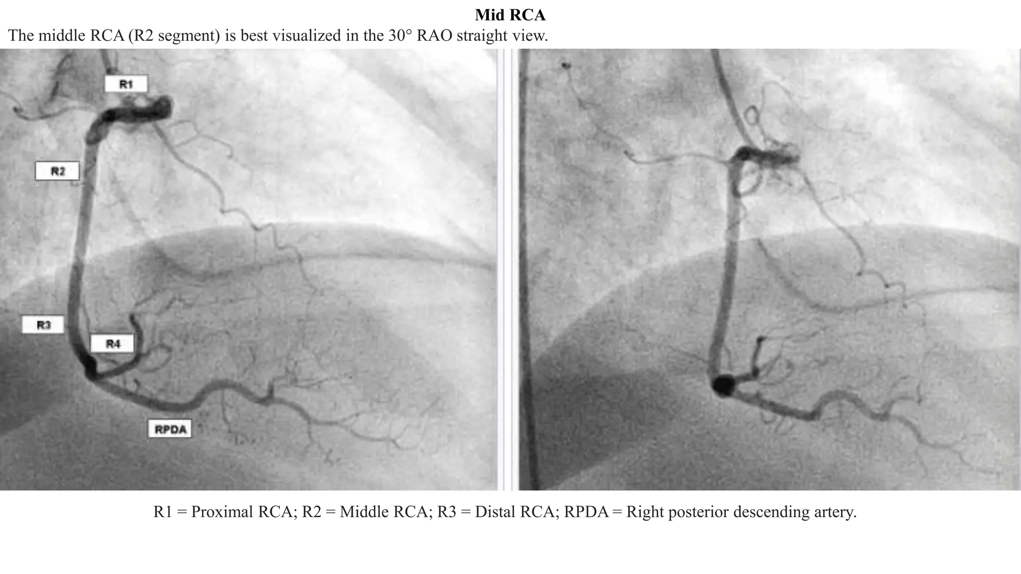 Coronary-artery Circulation Overview Observations about Kugel's artery ...