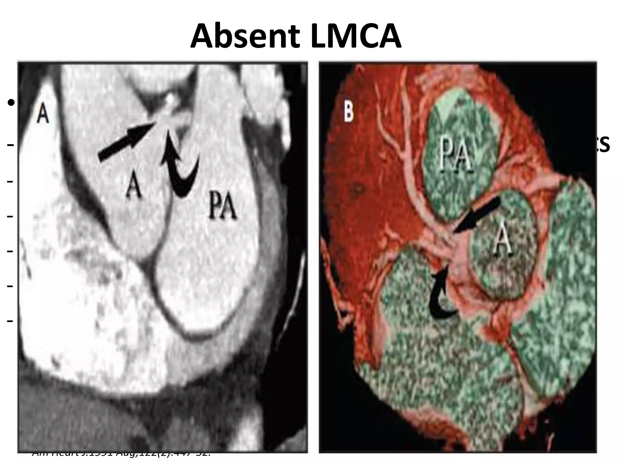 Coronary anatomy and angiographic views | PPTX